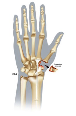 Thumb Arthritis - JOI Jacksonville Orthopaedic Institute