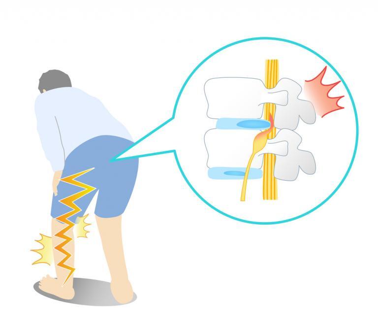 Lifting And Bending Properly - Jacksonville Orthopaedic Institute