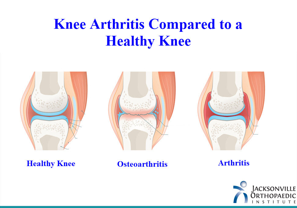 Knee Pain: Causes, Diagnosis, Treatments - JOI & JOI Rehab