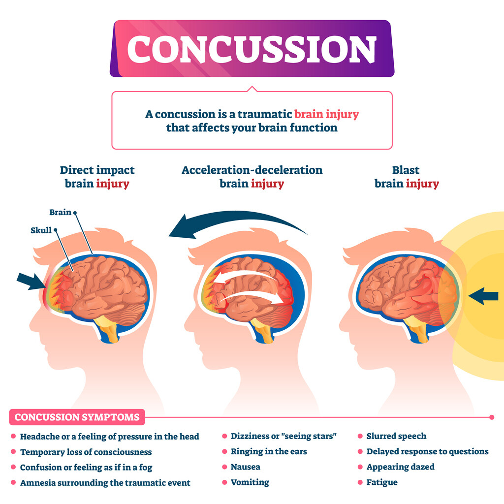 Concussion Lifestyle Changes JOI Jacksonville Orthopaedic Institute Concussion Lifestyle Changes JOI Jacksonville Orthopaedic Institute