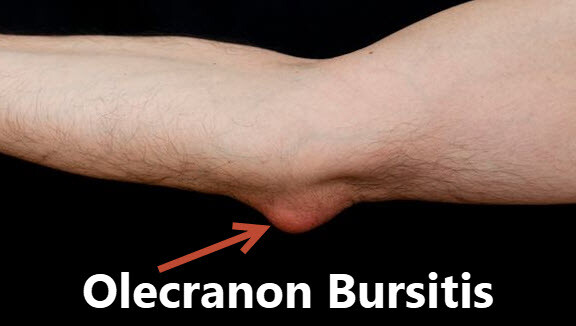 Elbow Pain - JOI Jacksonville Orthopaedic Institute