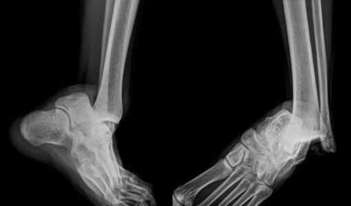 Ankle dislocation - JOI Jacksonville Orthopaedic Institute