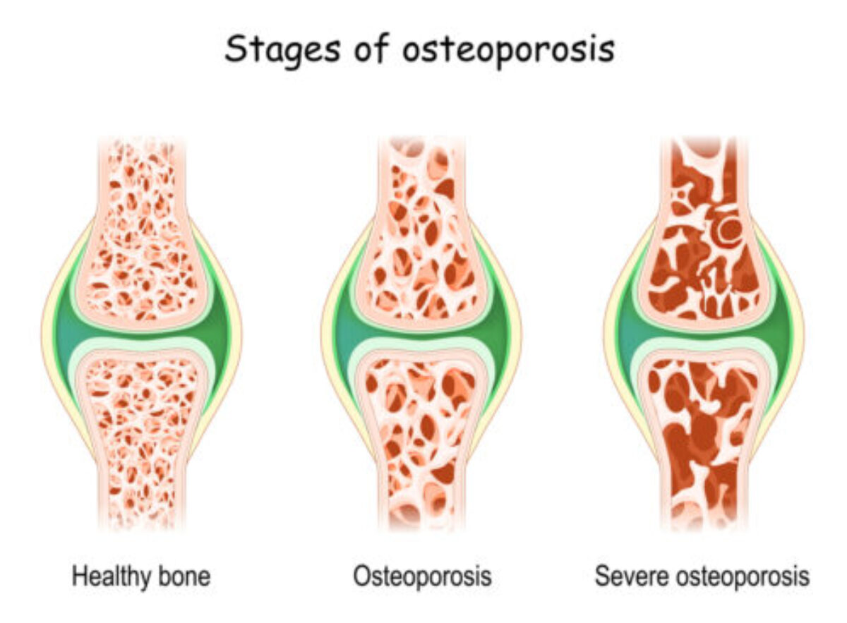 Osteoporosis Definition Discount Wholesale Www oceanproperty co th Osteoporosis Definition Discount Wholesale Www oceanproperty co th