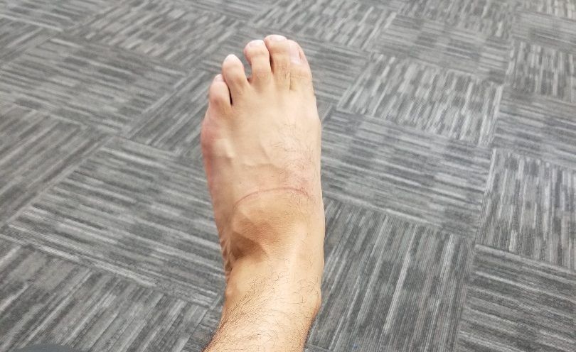 Dislocación del dedo del pie y del pie - JOI Jacksonville Orthopaedic ...