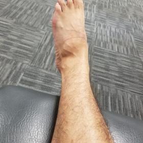 Ankle Physical Therapy - JOI Jacksonville Orthopaedic Institute