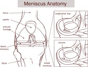 Meniscal Injuries - JOI Jacksonville Orthopaedic Institute