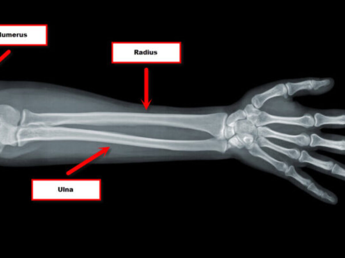 Distal Radius Fracture Signs Symptoms Causes And 46 OFF Distal Radius Fracture Signs Symptoms Causes And 46 OFF