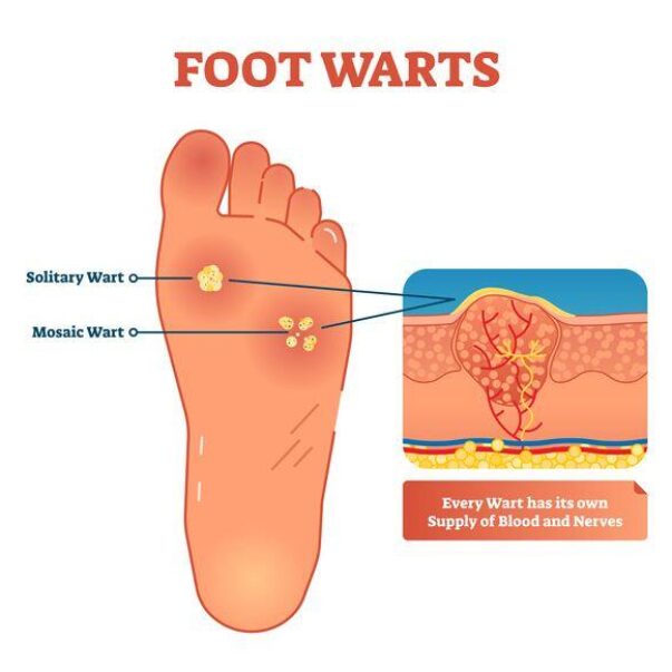 Plantar Wart Removal Stages Removal Progress Pics With Sa Plantar 6324