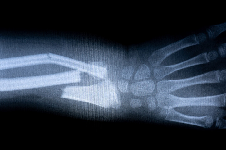 Forearm Fractures - JOI Jacksonville Orthopaedic Institute