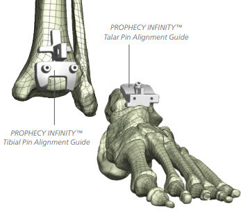 Ankle Replacement - JOI Jacksonville Orthopaedic Institute