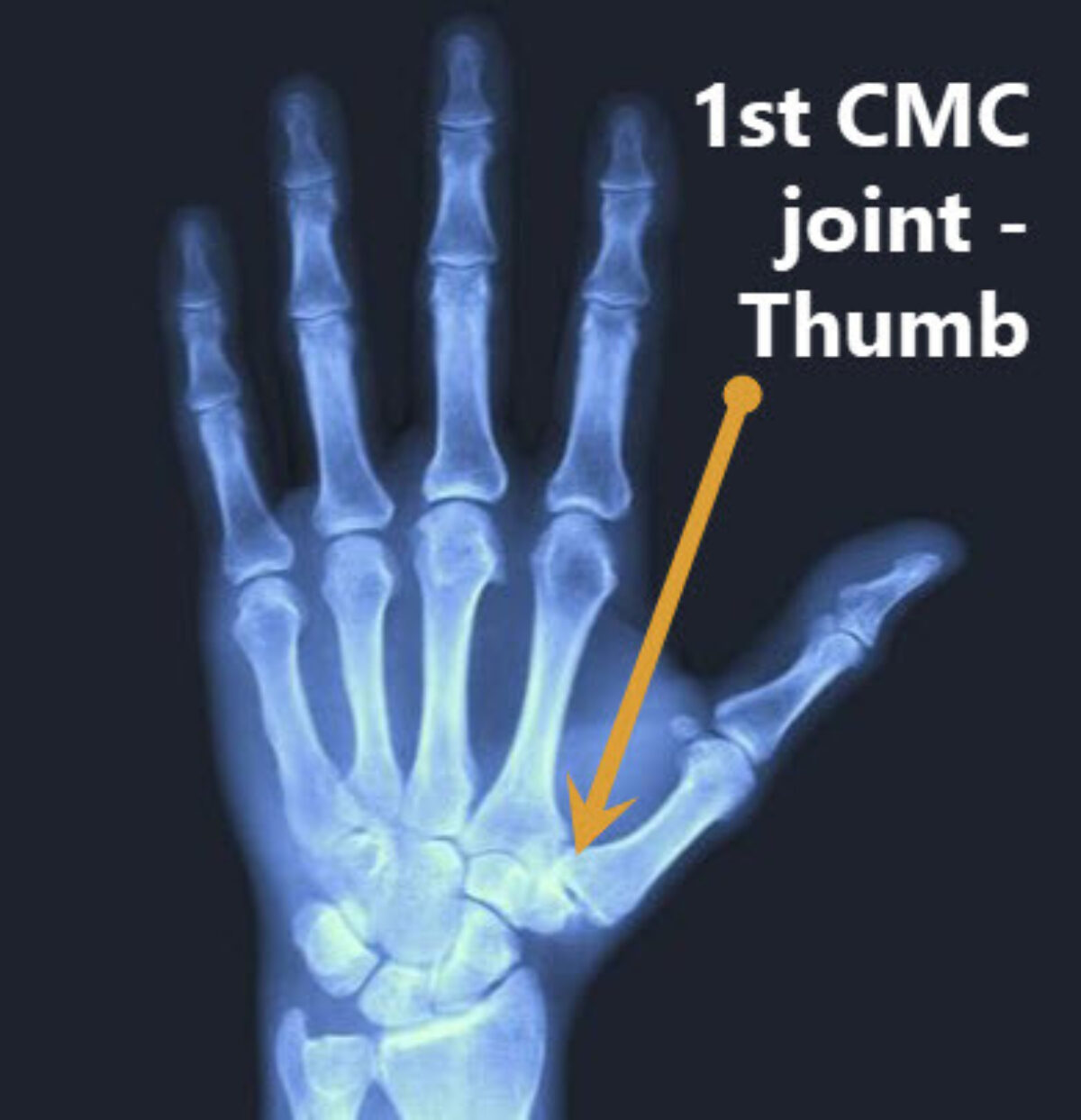 Osteoarthritis X Ray Hand
