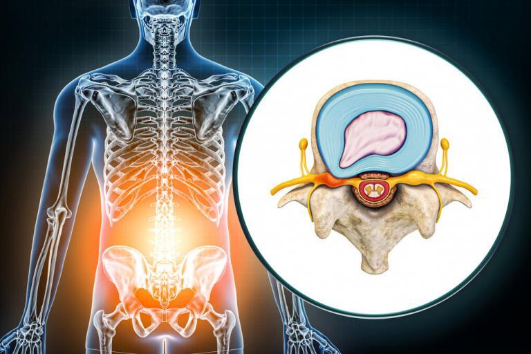 Cauda Equina Syndrome - JOI Jacksonville Orthopaedic Institute