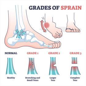 Ankle Sprains: Inversion vs. Eversion - JOI and JOI Rehab