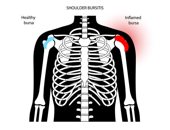 Bursitis of the Shoulder - JOI Jacksonville Orthopaedic Institute