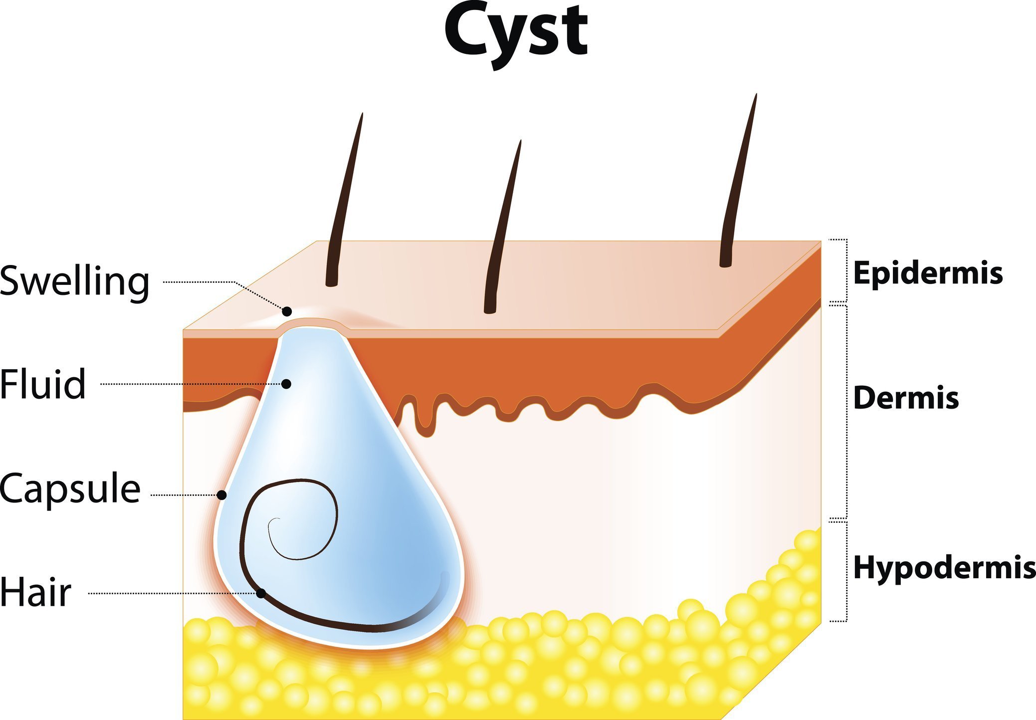 Popliteal Cyst - JOI Jacksonville Orthopaedic Institute