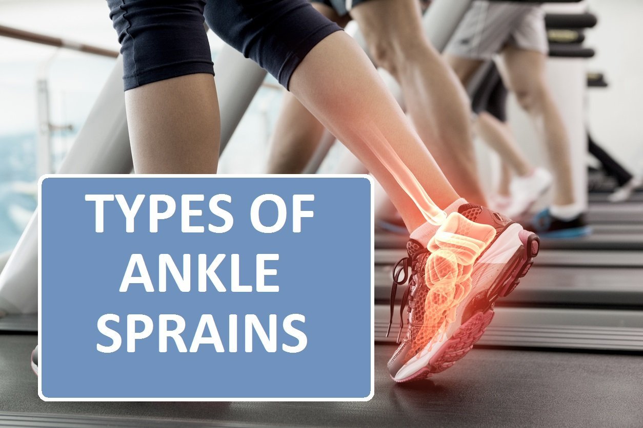 What Are The Types of Ankle Sprains? - JOI Jacksonville Orthopaedic ...
