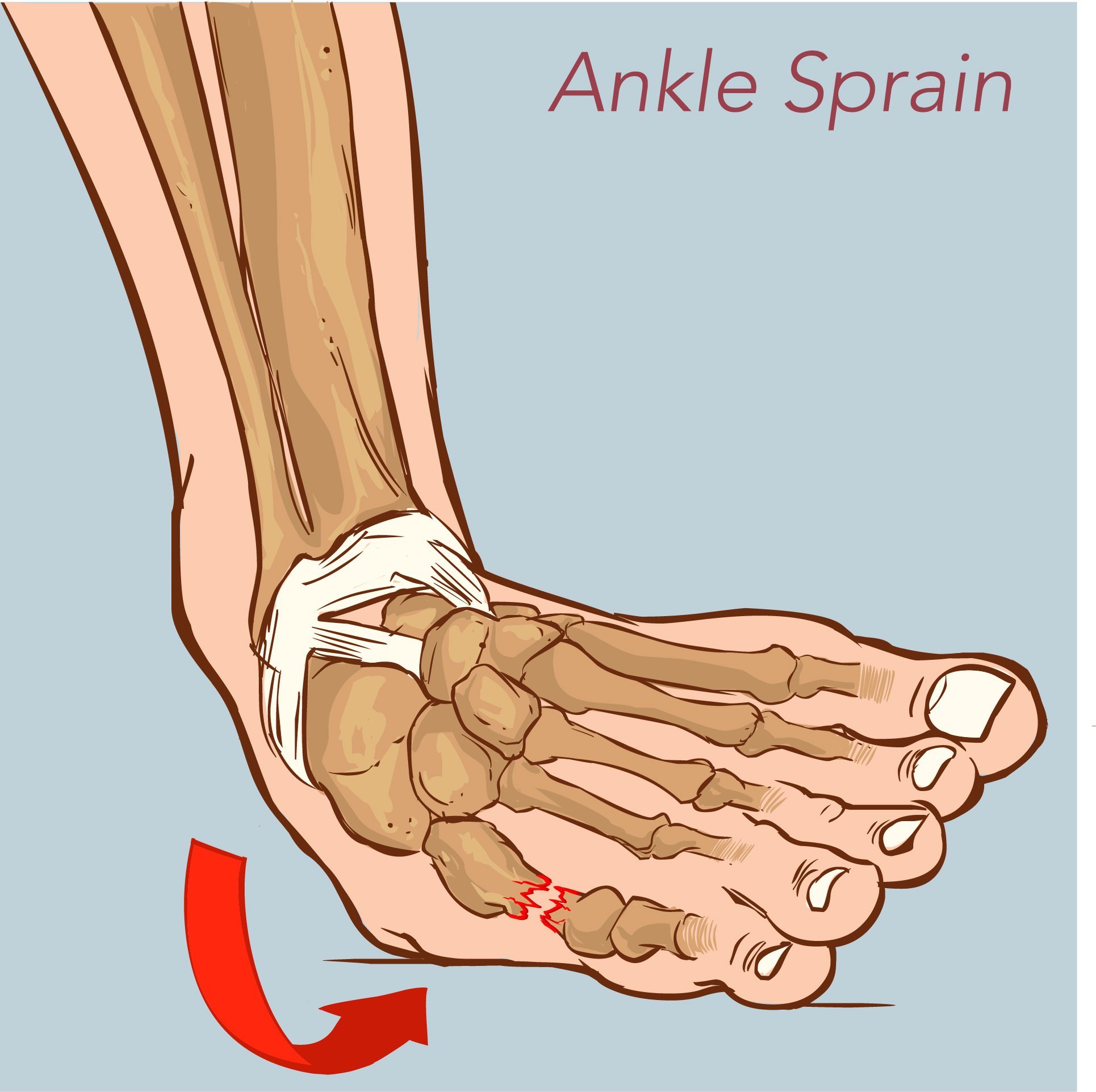 How to Tell the Difference Between a Sprain or Broken Ankle - JOI ...