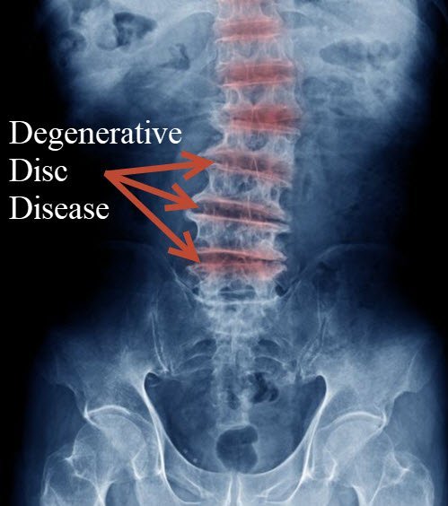 Degenerative Disc Disease - JOI Jacksonville Orthopaedic Institute