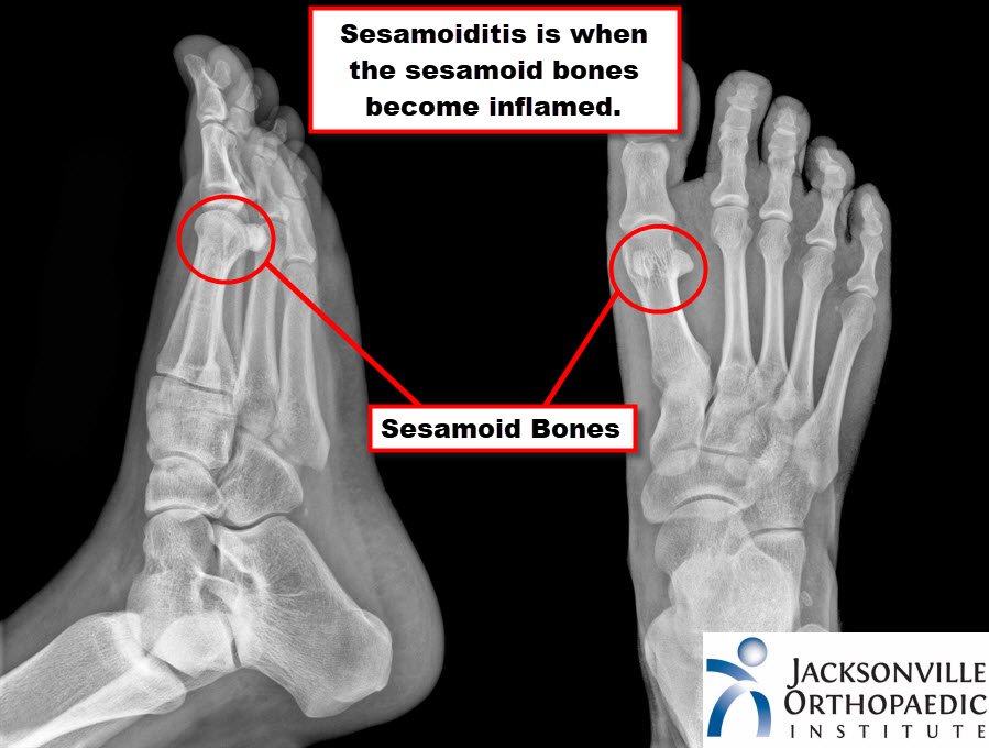 What Is Sesamoiditis Jacksonville Orthopaedic Institute What Is Sesamoiditis Jacksonville Orthopaedic Institute