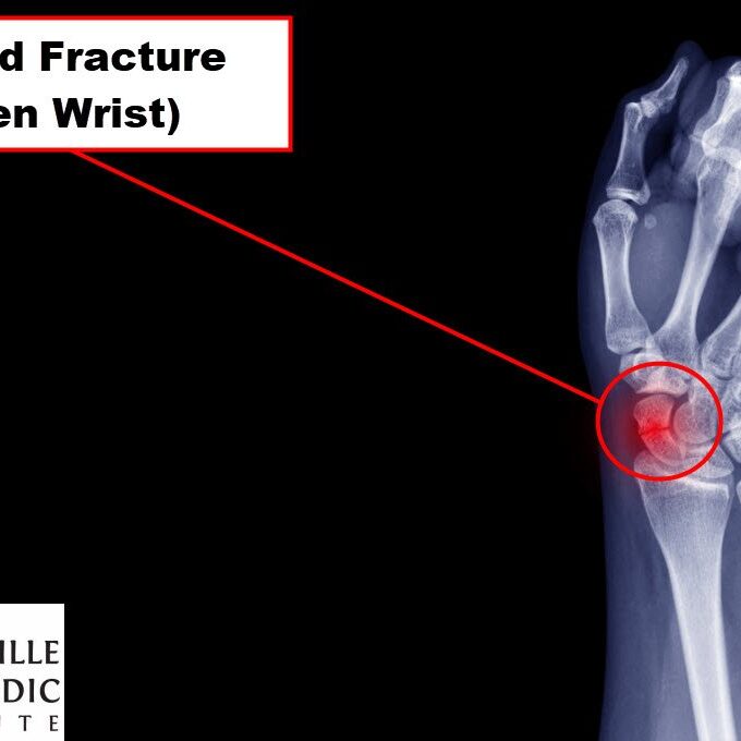 Hairline Fracture X Ray Of Right Hand Can You Always See A Fracture In