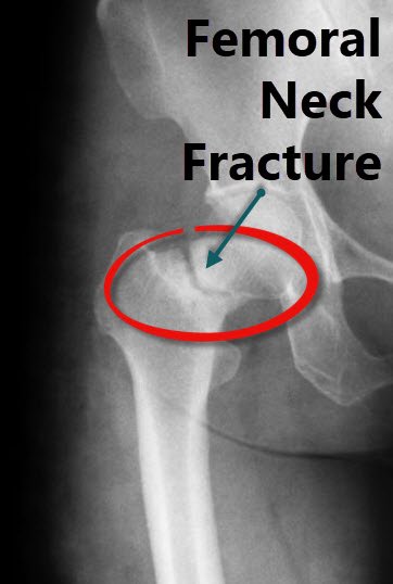 Femoral Neck Fractures - JOI Jacksonville Orthopaedic Institute