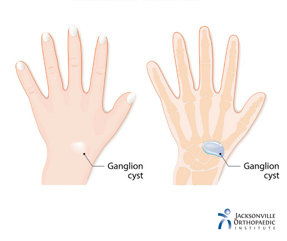 Ganglion Cyst Jacksonville Orthopaedic Institute Ganglion Cyst Jacksonville Orthopaedic Institute
