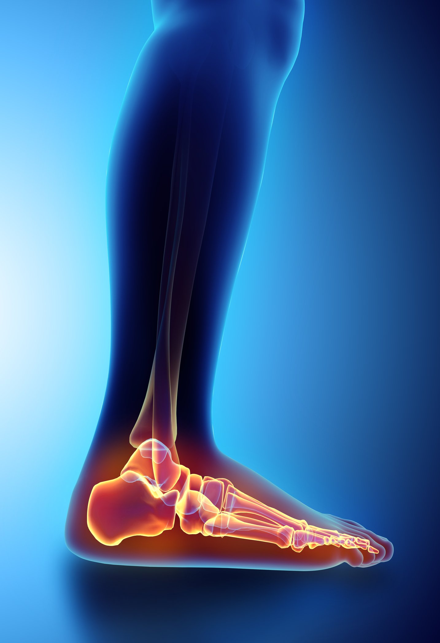 Hindfoot Fusion - A Comprehensive Guide - JOI Jacksonville Orthopaedic ...