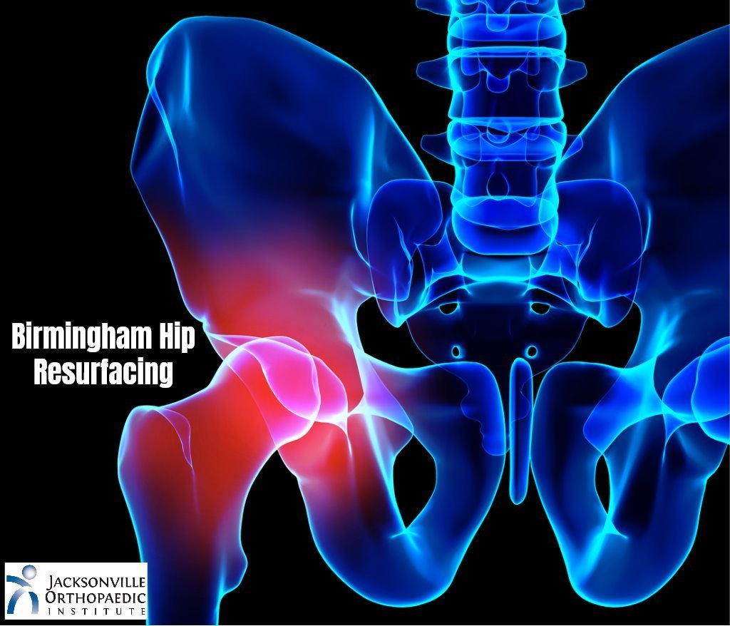 What is Birmingham Hip Resurfacing? - JOI Jacksonville Orthopaedic ...